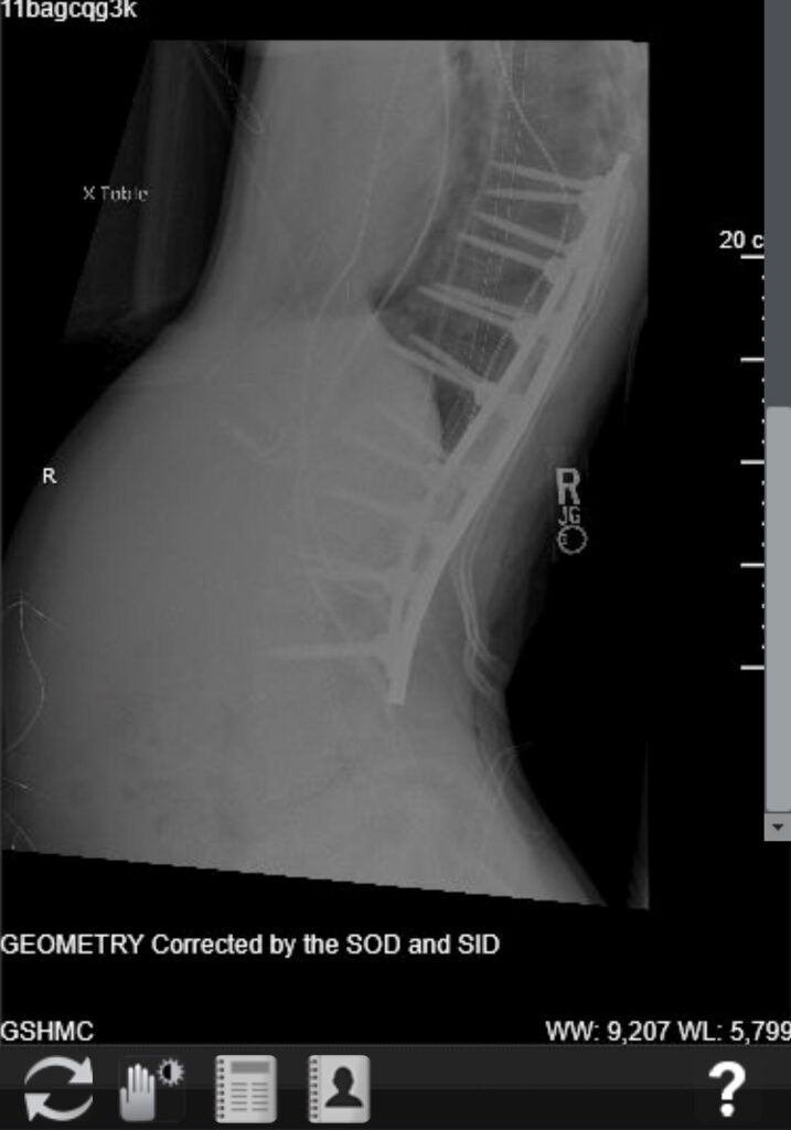 Case Study: Posterior Column Osteotomies | Dr. Salvatore Zavarella, DO ...