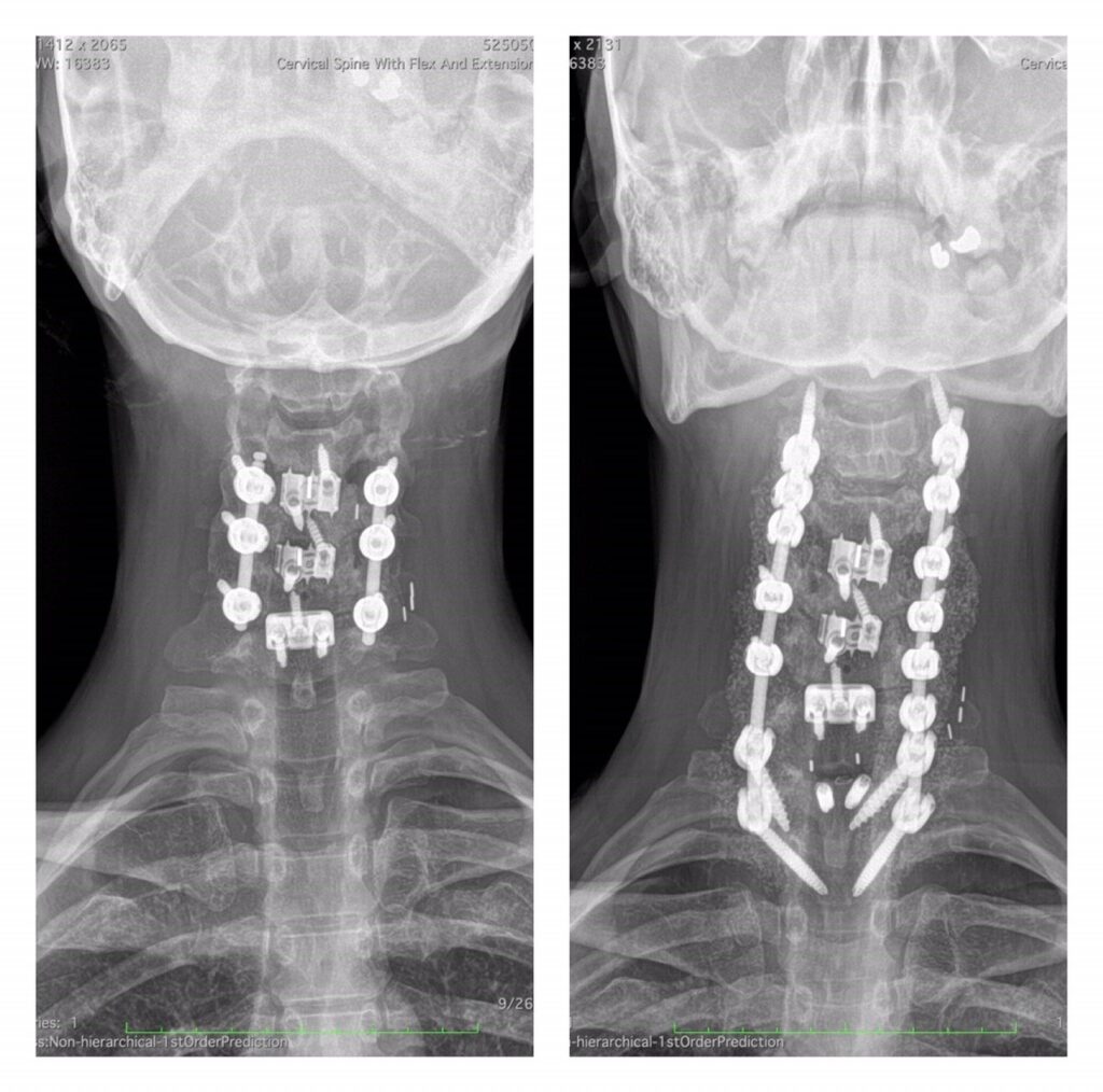 Case Study: Anterior Cervical Discectomy and Fusion | Dr. Salvatore ...