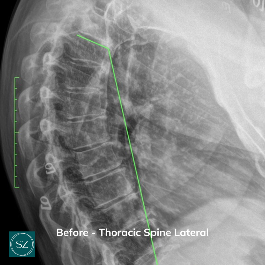 Case Study: Correction of Chin-to-Chest Deformity | Dr. Salvatore ...