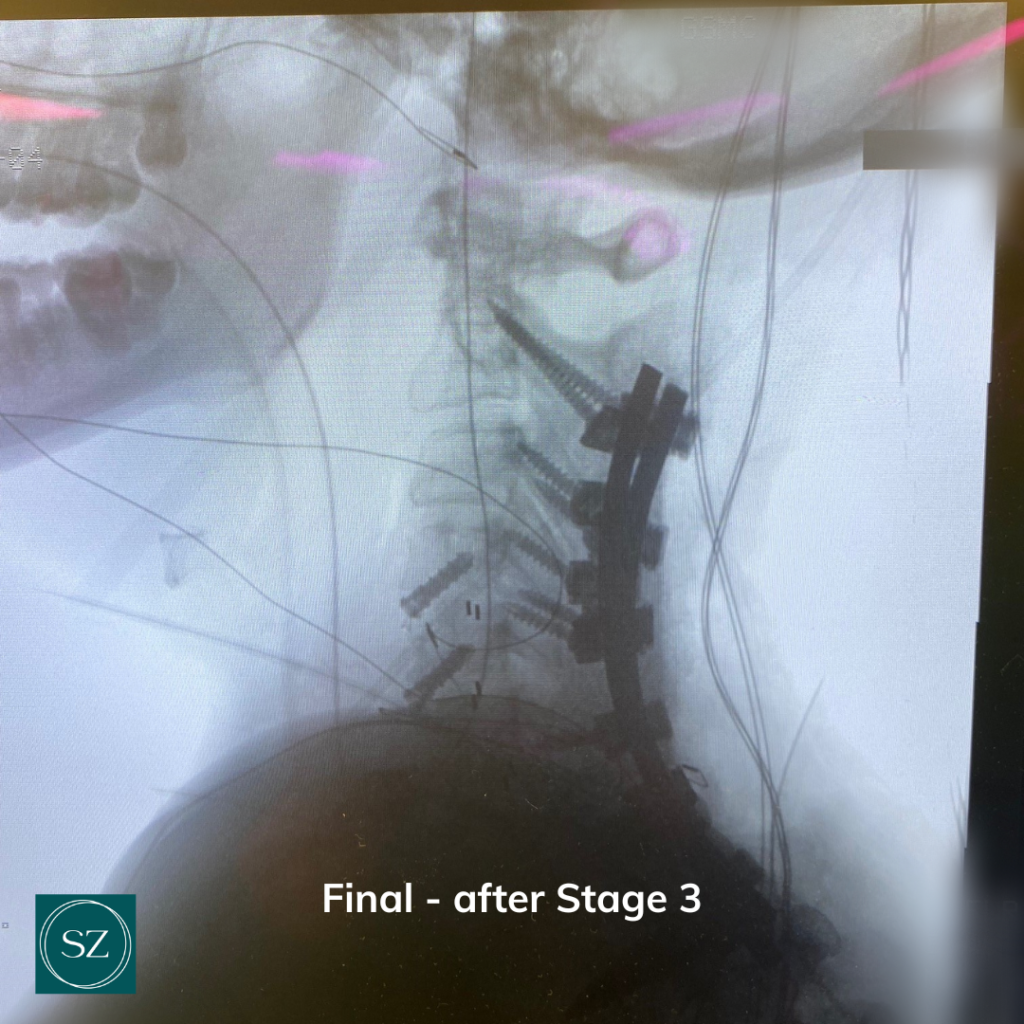 Case Study: Correction of Chin-to-Chest Deformity | Dr. Salvatore ...